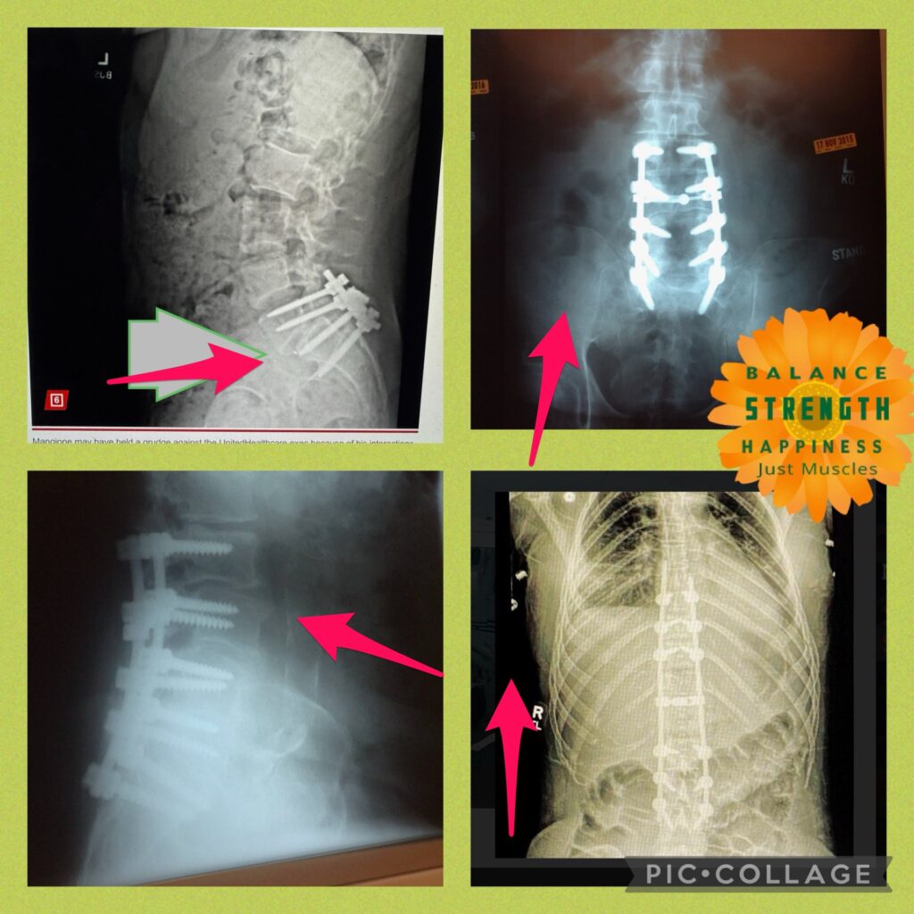 Just Muscles 😧BACK surgery is like.... - Just Muscles